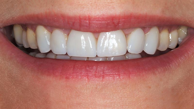 Diseño Digital de Sonrisas - DSD - Clínica Dental Santisteban